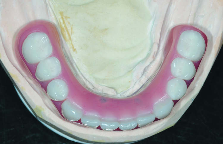 Treatment options for the edentulous arch